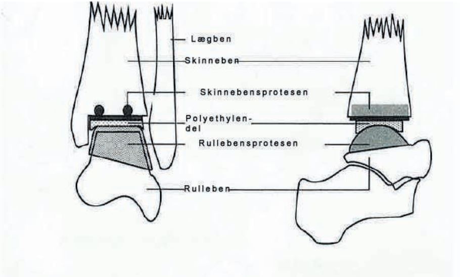 Indsættelse af kunstigt ankelled - Fodkirurgi, ankelkirurgi, nedgroet ...